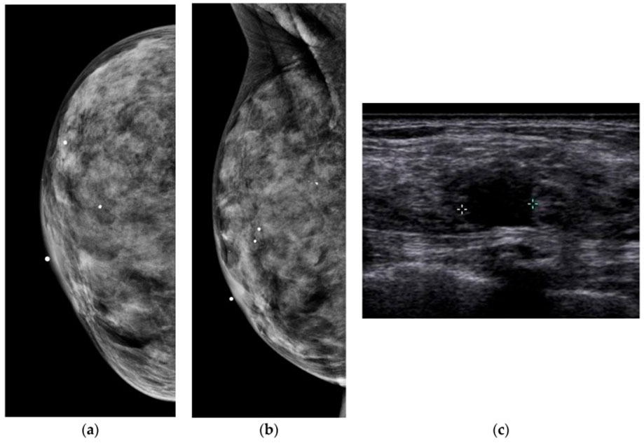 Coeur d'Alene Ultrasound - Whole Breast Ultrasound Screening